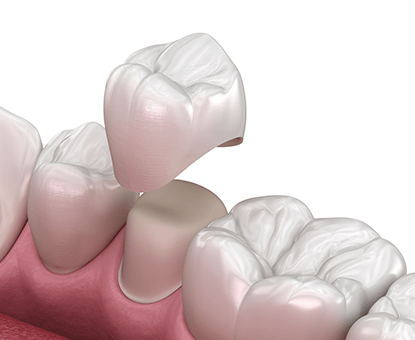Natural-Looking Dental Crowns | Zirconia Crowns | Smil